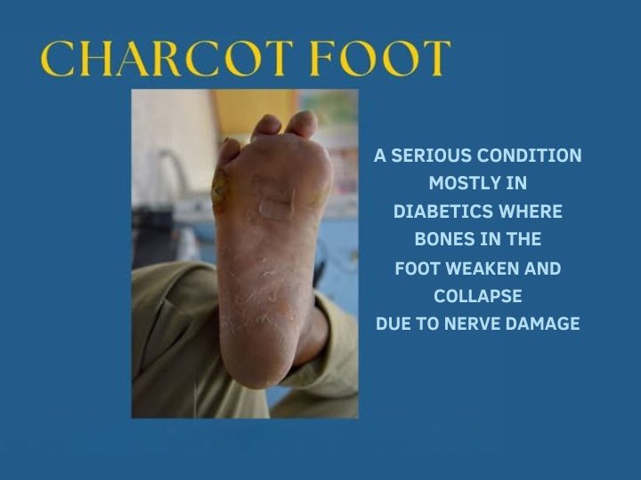The “Silent Destroyer”: Understanding Charcot Foot - NaplesPodiatrist