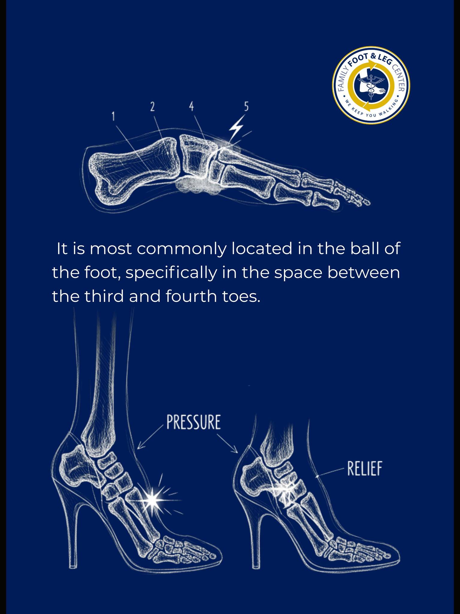 Morton’s Neuroma: Understanding the Pain in the Ball of Your Foot ...
