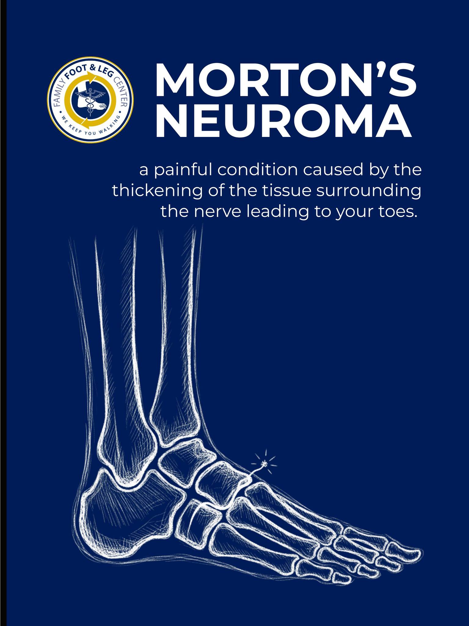 Morton’s Neuroma: Understanding the Pain in the Ball of Your Foot ...